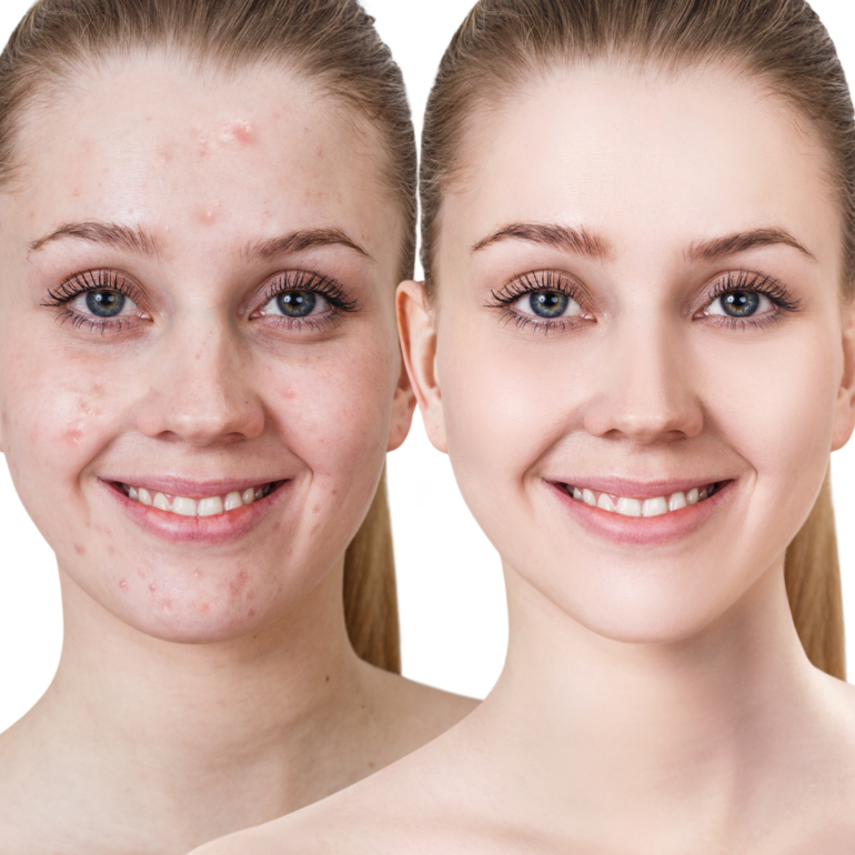 Genesis/Angiomas/Rosacea V-Laser – Aida Clinic